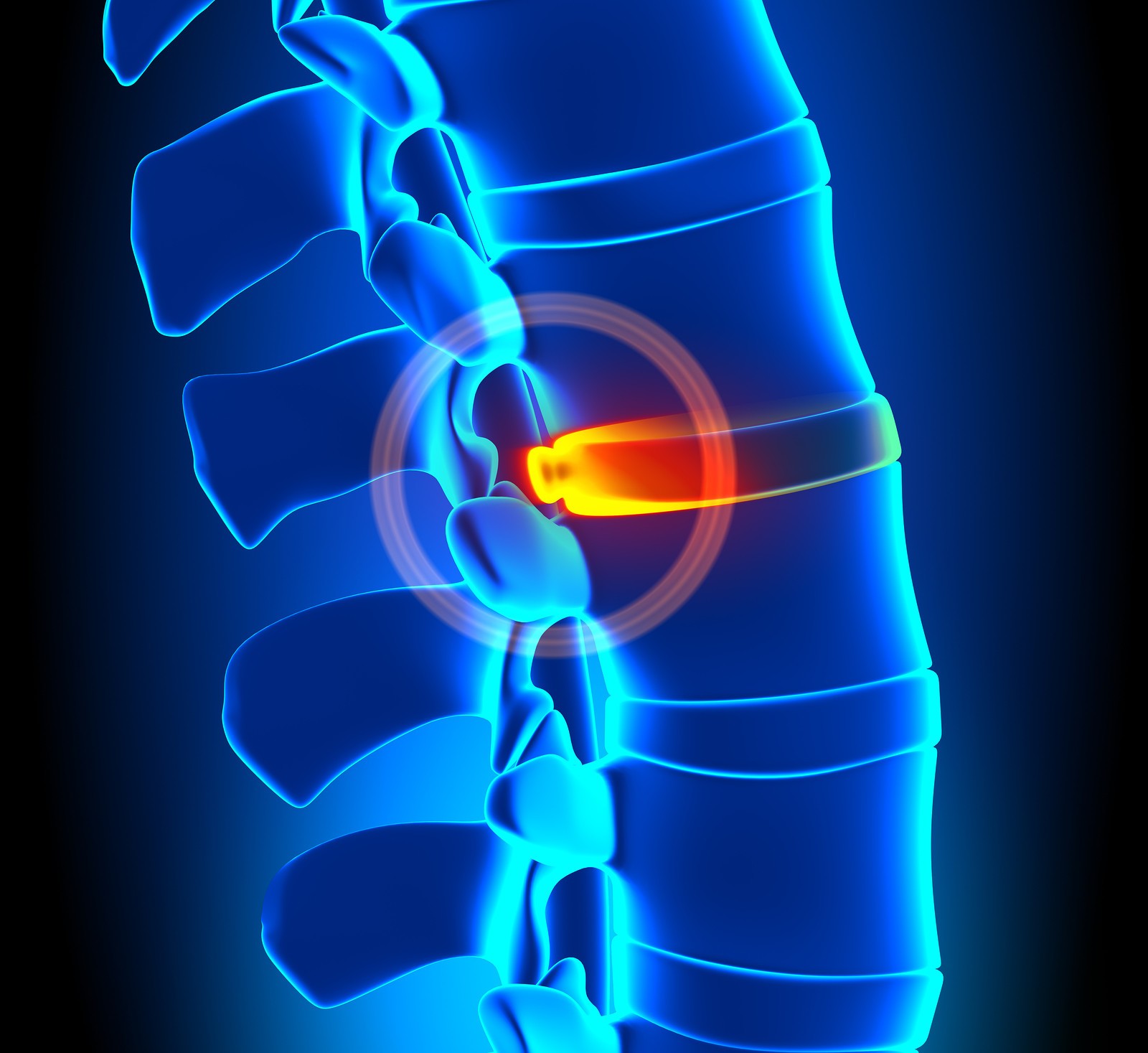 Dynamic Health, Jersey Chiropractor - Top Tips for Slipped Disc Relief